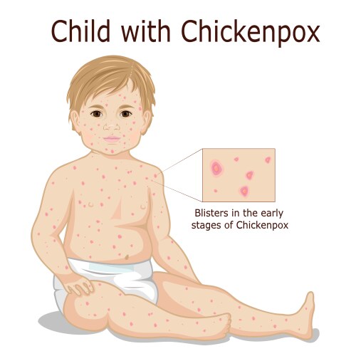 A child with rubella Royalty Free Vector Image