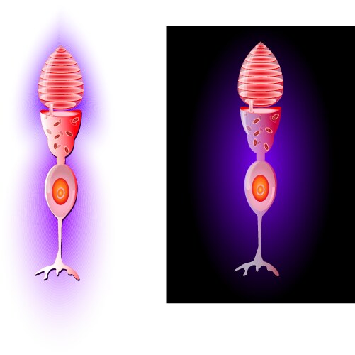 Keratoconus normal cornea and cone shaped Vector Image