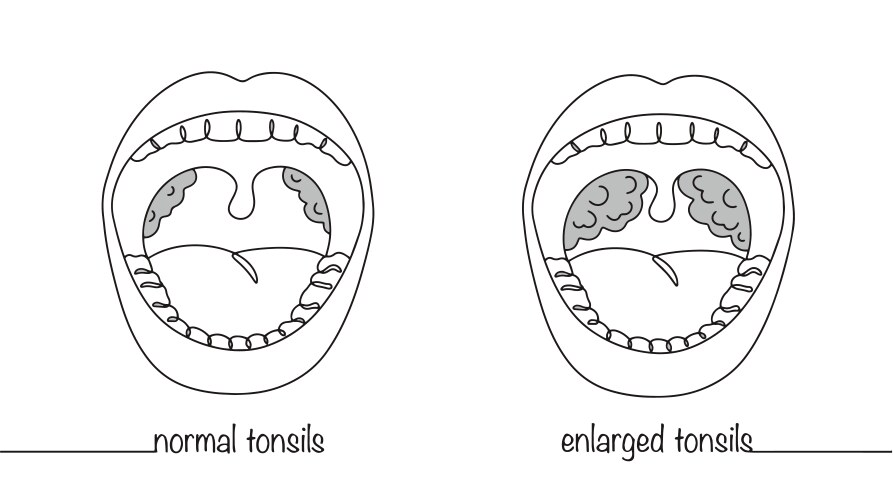 Tonsils Tonsil Anatomy Adenoid Adenoids Gross Counter Sagittal Anterior ...