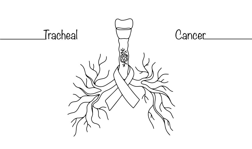 Laryngeal cancer Royalty Free Vector Image - VectorStock