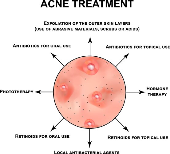 Causes acne pustules papules comedones Royalty Free Vector