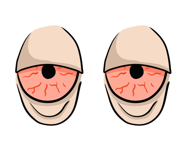 Red hand-drawn eyes problem of insomnia Royalty Free Vector
