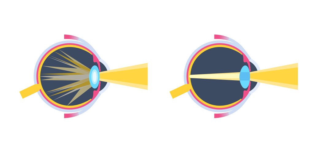 Cataract eye disease Royalty Free Vector Image