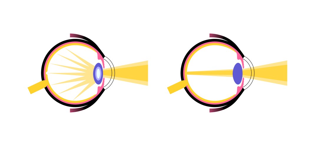 Cataract eye disease Royalty Free Vector Image