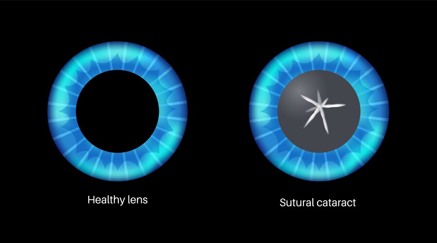 Cataract eye disease Royalty Free Vector Image