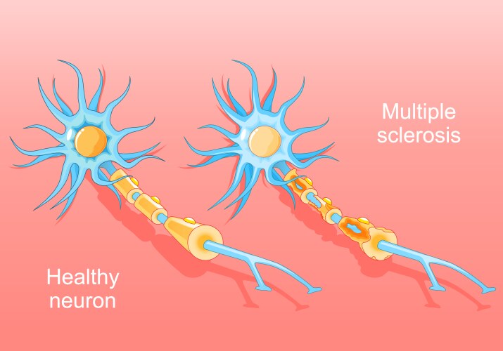 Multiple Sclerosis Vector Images (over 460)