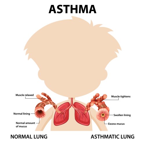 Bronchial asthma diagram with normal airway Vector Image