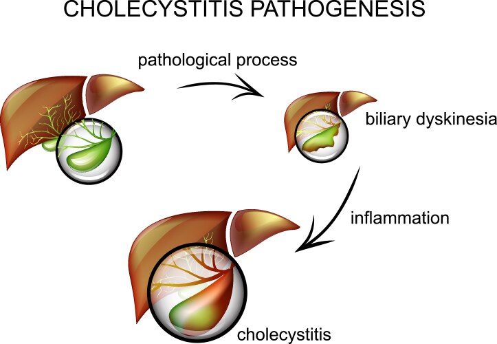 Pathogenesis of gallstones Royalty Free Vector Image