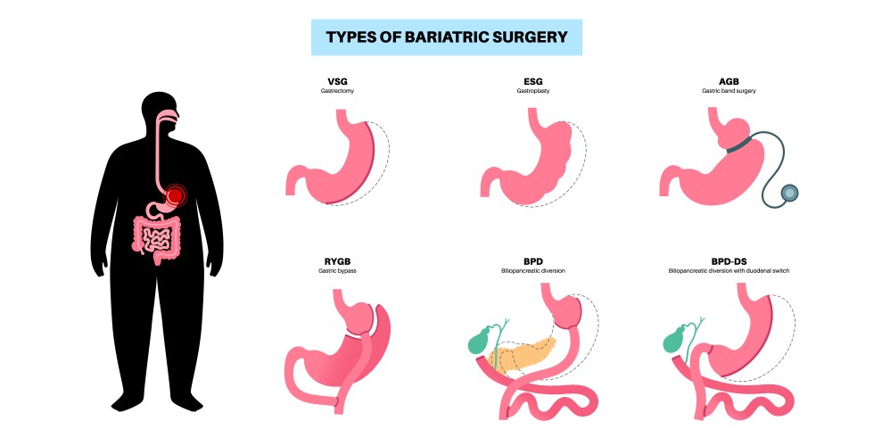 Bariatric surgery poster Royalty Free Vector Image