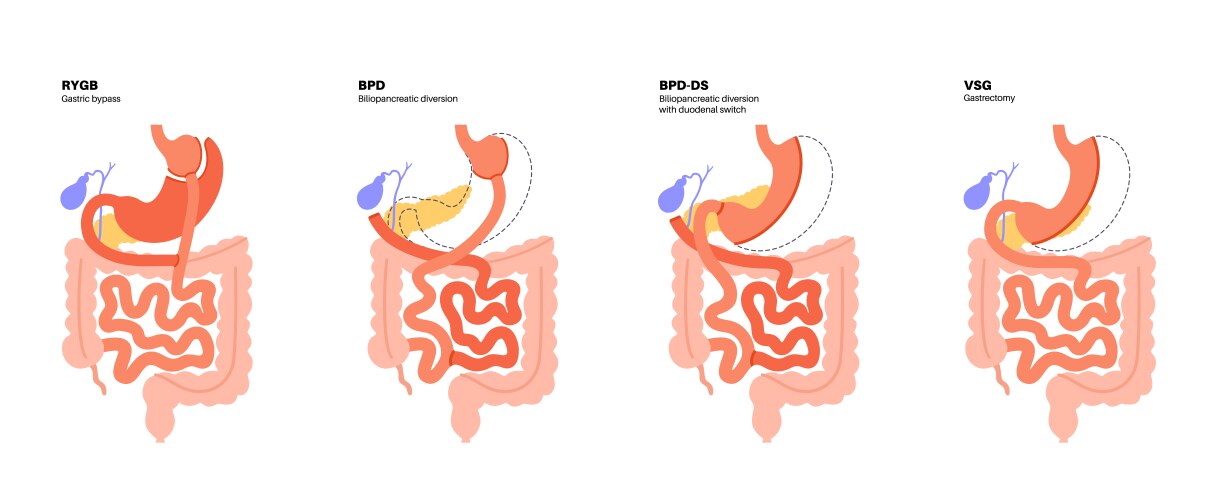 Bariatric surgery poster Royalty Free Vector Image