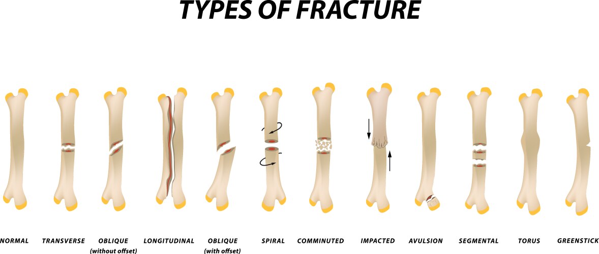 Types fracture bone set infographics Royalty Free Vector