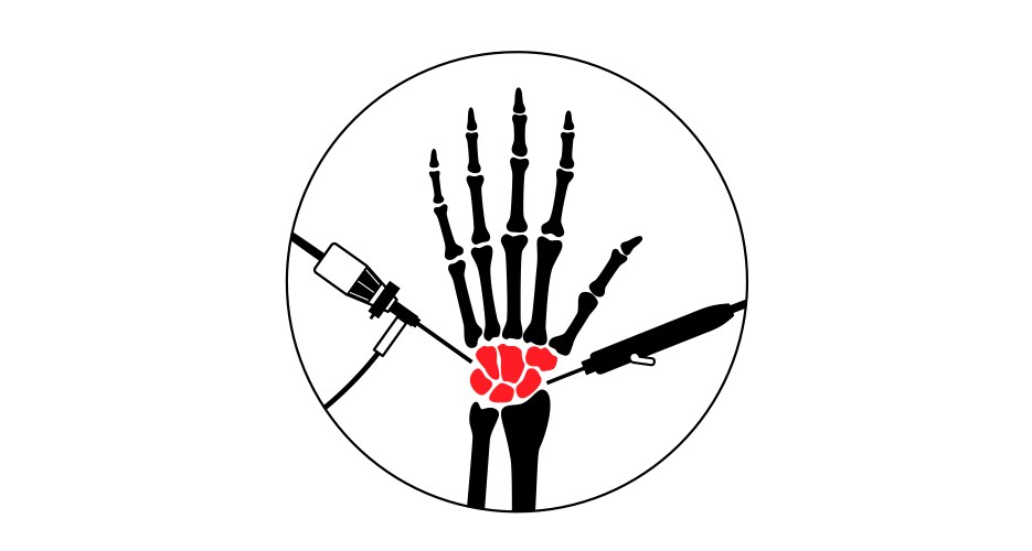 Wrist arthroscopy surgery Royalty Free Vector Image