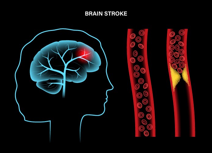Brain Stroke Vector Images (over 8,300)