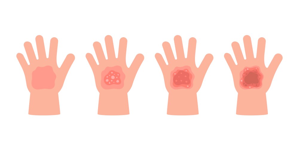 Burn Wound Vector Images (over 550)