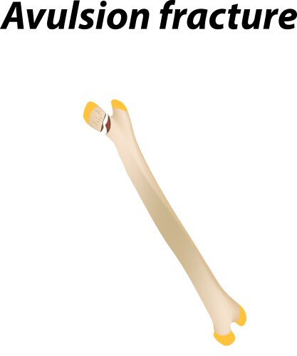 Transverse bone fracture infographics Royalty Free Vector