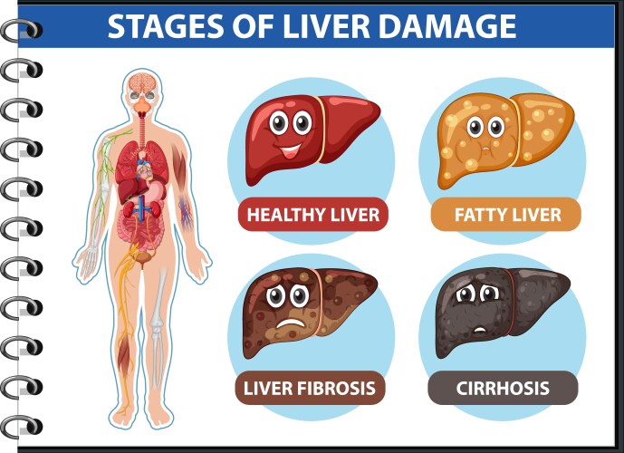 Diagram showing stages of liver damage Royalty Free Vector Diagram showing stages of liver damage Royalty Free Vector
