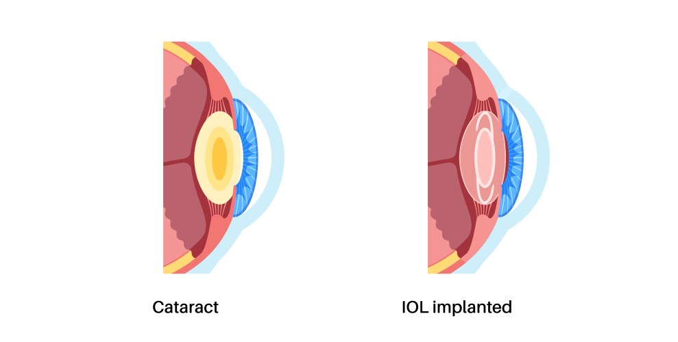 Intraocular lenses poster Royalty Free Vector Image