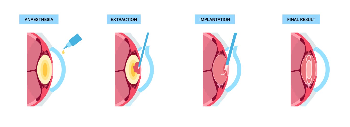 Cataract surgery poster Royalty Free Vector Image