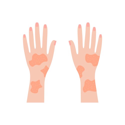 Skin allergy set hands covered red rash Royalty Free Vector