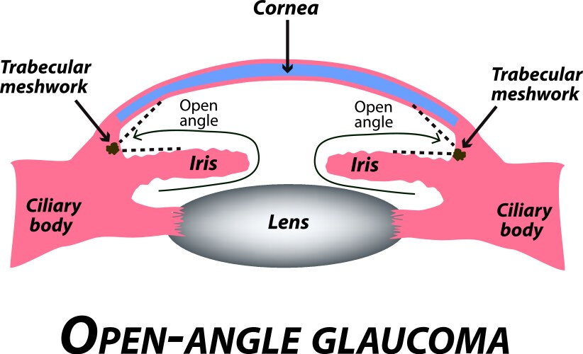 Glaucoma the structure of eye field Royalty Free Vector