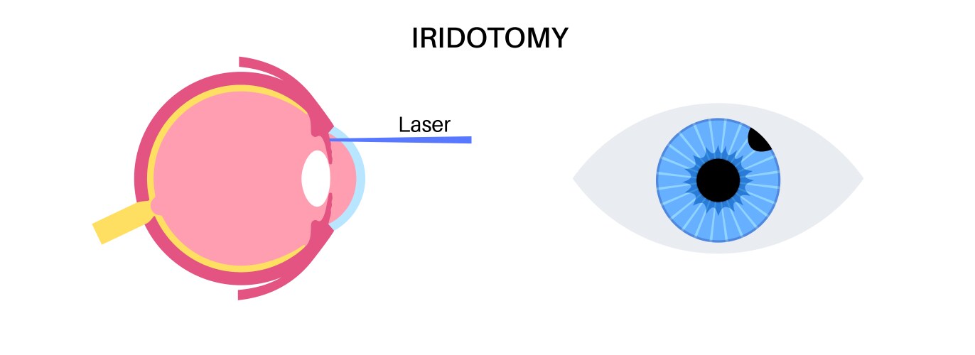 Iridectomy medical poster Royalty Free Vector Image
