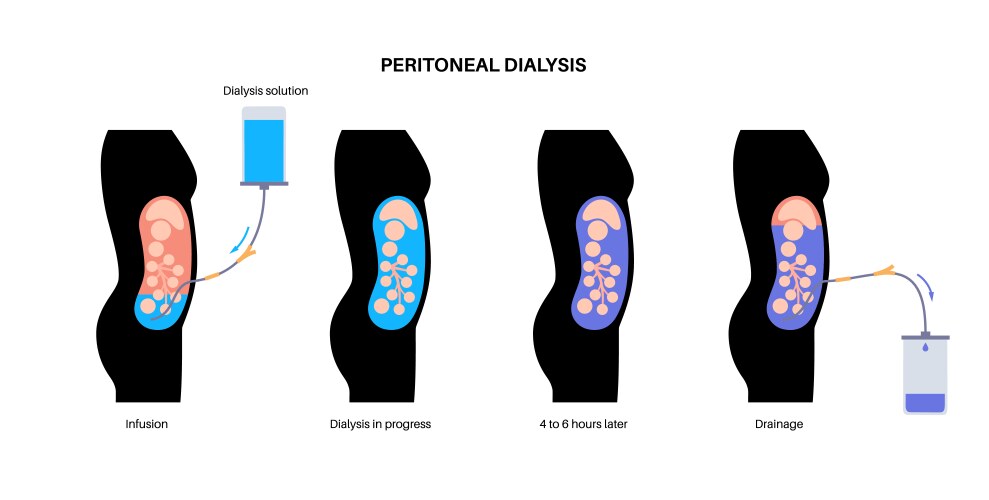 Peritoneal dialysis concept Royalty Free Vector Image