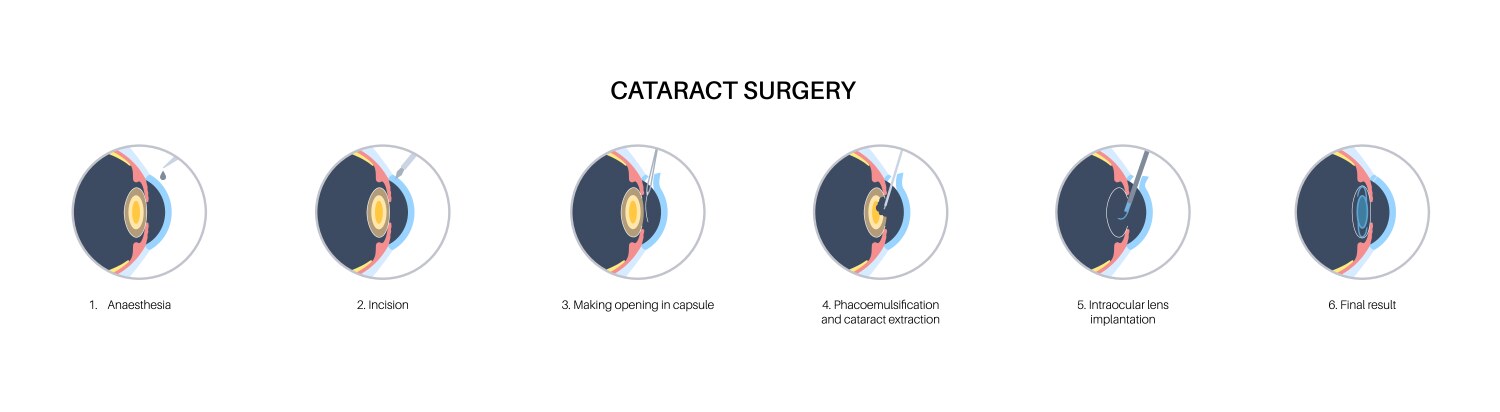 Cataract surgery poster Royalty Free Vector Image