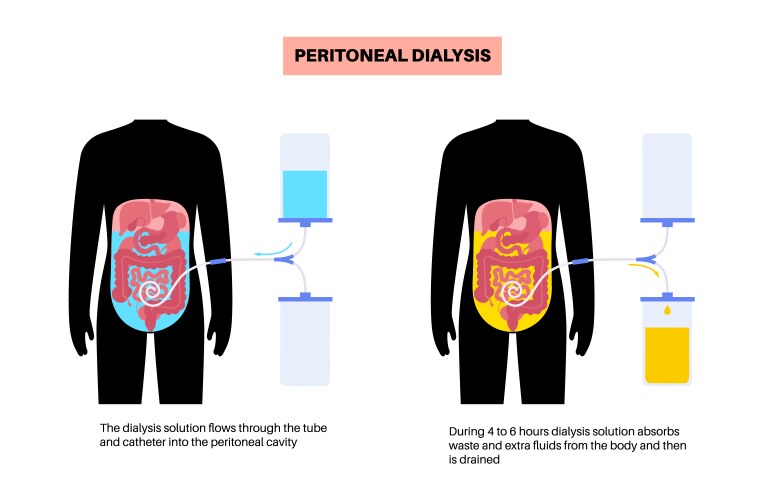 Peritoneal Dialysis Vector Images (44)