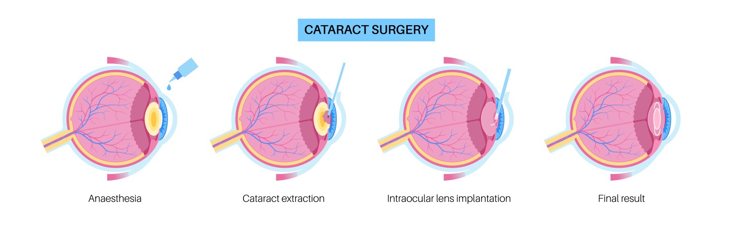 Cataract surgery poster Royalty Free Vector Image