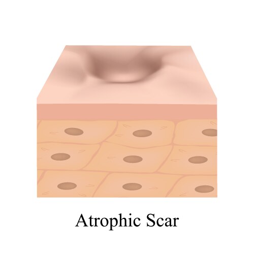 Scars normotrophic the anatomical structure Vector Image