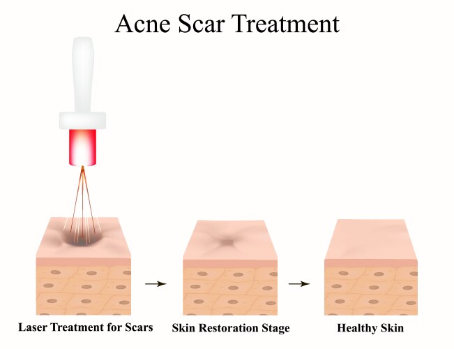 Types scars acne keloid hypertrophic Royalty Free Vector