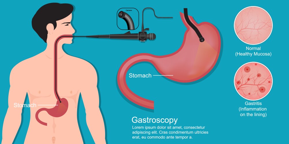 Gastroscopy Vector Images (over 1,000)
