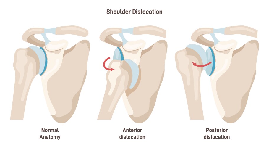 Shoulder Dislocation Vector Images (66)