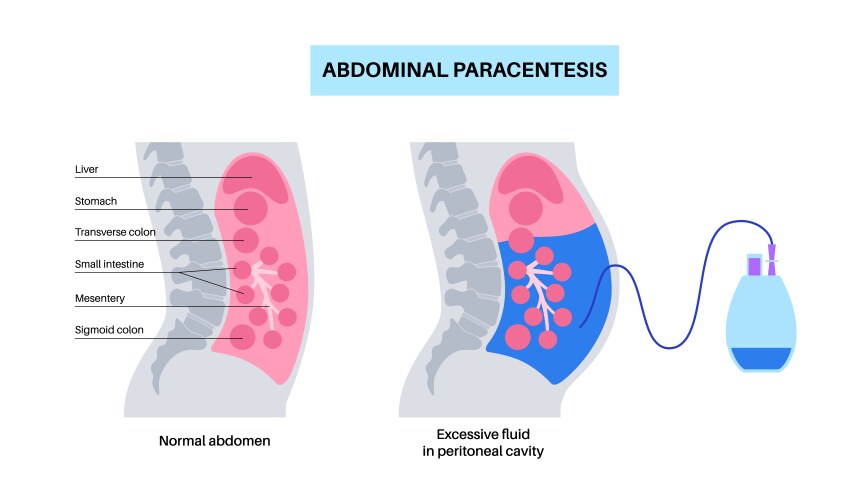 Peritoneum Vector Images (over 110)