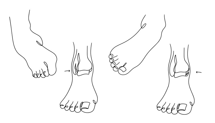 Metacarpal fracture Royalty Free Vector Image - VectorStock