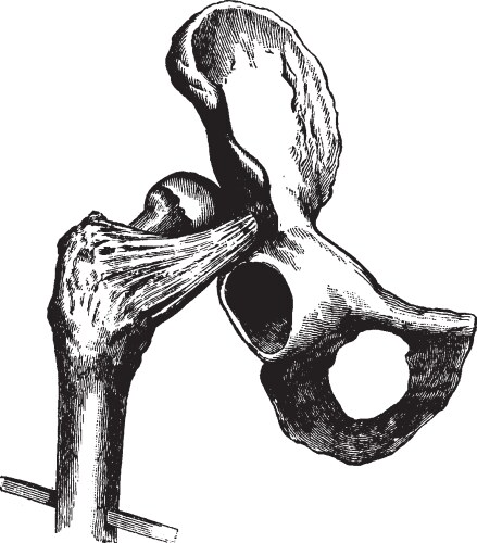 Hip Dislocation Vector Images (28)