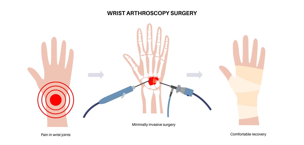 Wrist arthroscopy surgery Royalty Free Vector Image