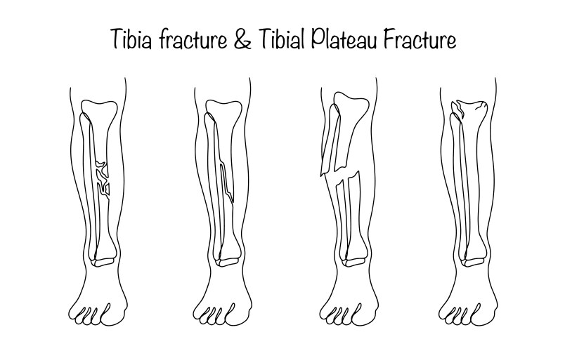Types of spinal fracture Royalty Free Vector Image