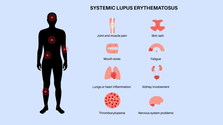 Systemic lupus erythematosus Royalty Free Vector Image
