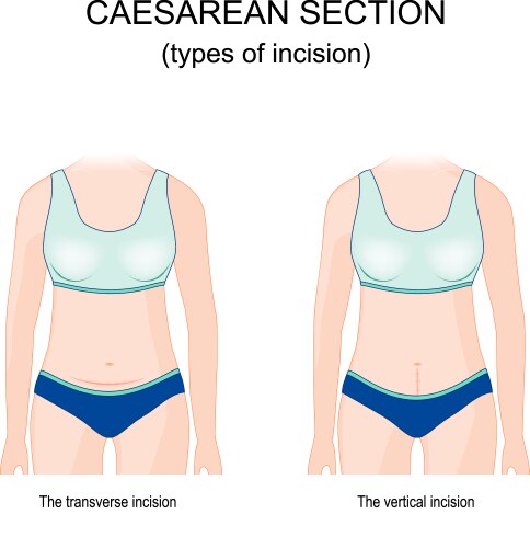 Caesarean Section Vector Images (27)