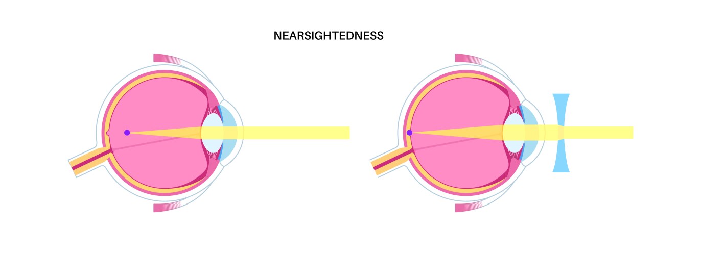Normal eye and nearsightedness Royalty Free Vector Image