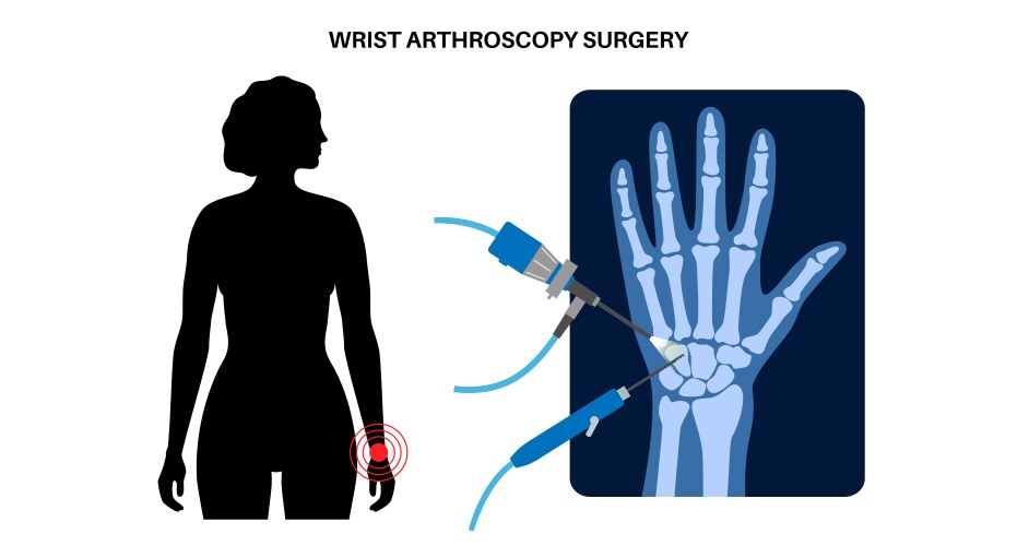 Wrist arthroscopy surgery Royalty Free Vector Image