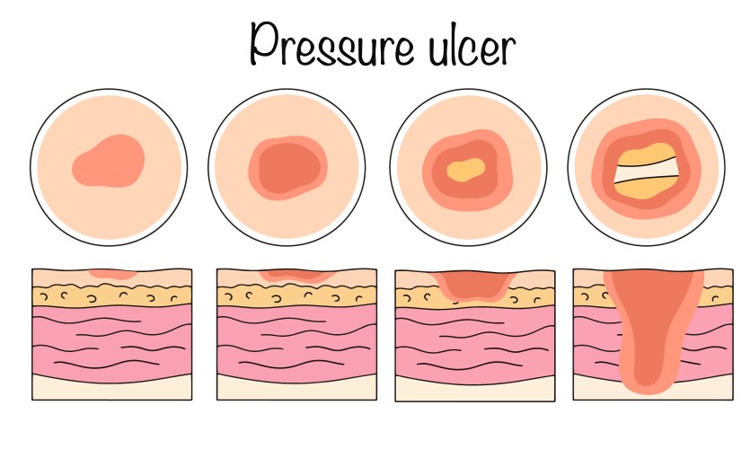 Skin Ulcer Vector Images (over 700)