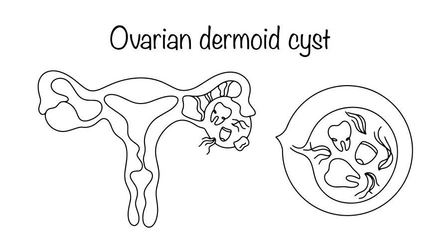 Ovarian Cyst Vector Images (over 110)