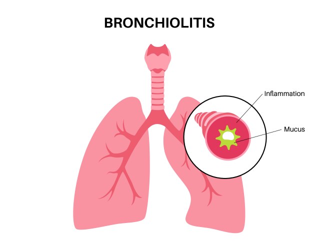 Bronchitis and bronchiolitis Royalty Free Vector Image
