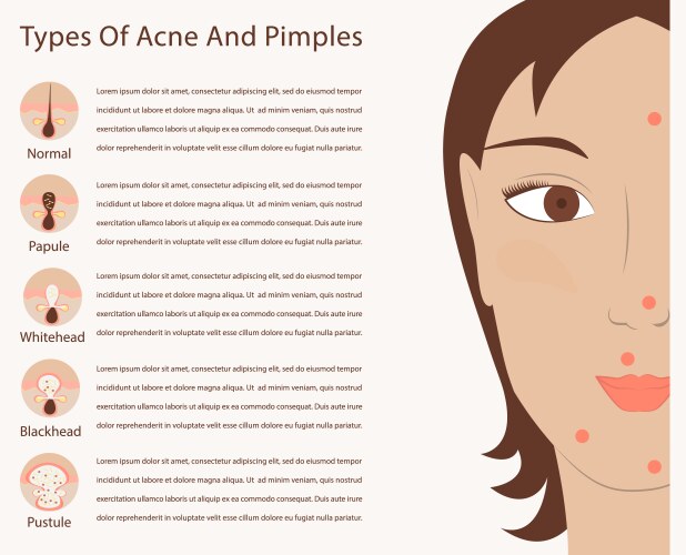 Icon set of pick at pimple popping acne – Royalty-Free Vector | VectorStock