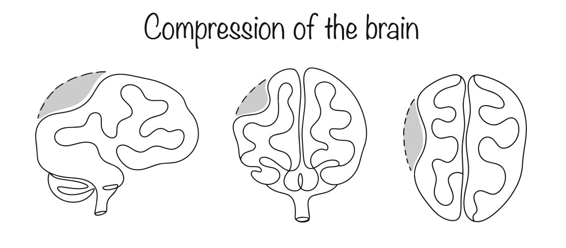 Traumatic Brain Injury Vector Images (over 130)