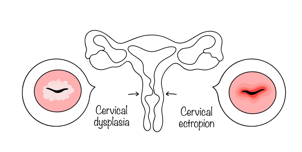 Cervix Vector Images (over 3,200)