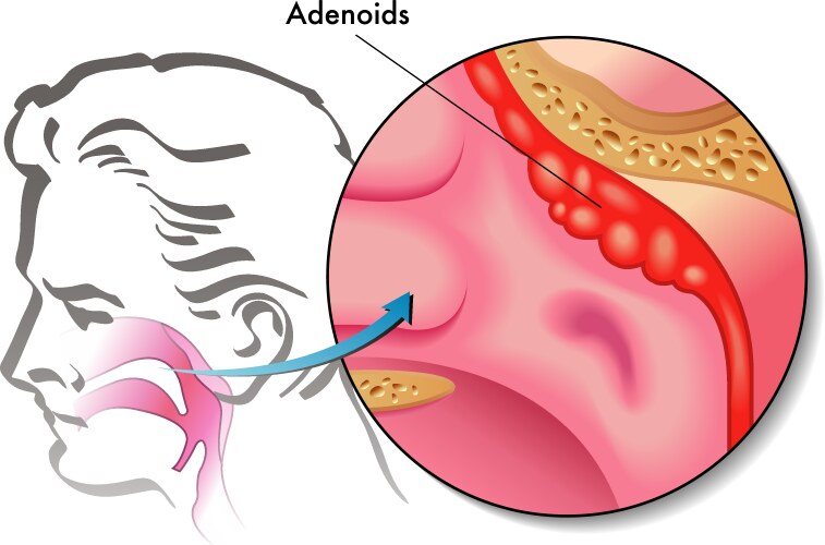 Nasal and throat nasopharynx diseases adenoids Vector Image