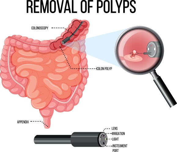 Diagram showing polyp removal in human Royalty Free Vector